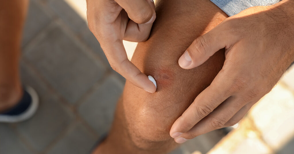 What Are The Best Bug Bite Treatments? | East End Tick Control®